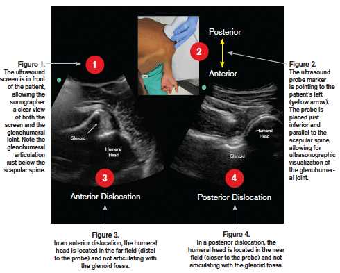 Traumagency: POCUS For Shoulder Dislocation