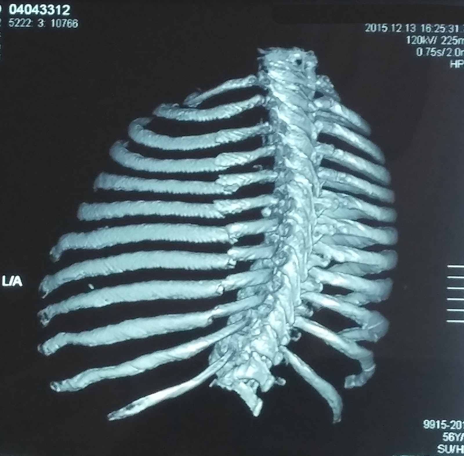 Revision Casos De Cirugia General: TORAX INESTABLE O TORAX FLOTANTE: