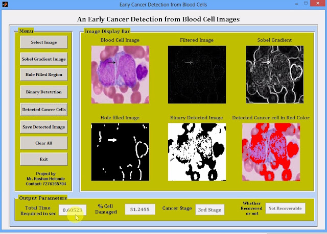 Leukemia (Blood) Cancer Detection Using Image Processing Matlab Project ...