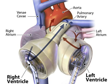 FIRST PATIENT IN THE WORLD BRIDGED TO A SUCCESSFUL HEART TRANSPLANT VIA ...