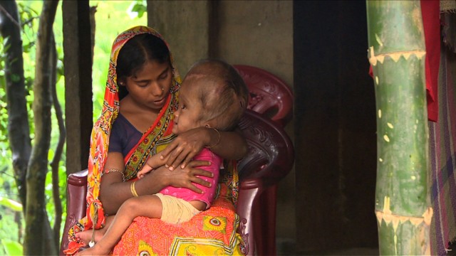 Indian Child, Roona Begum Recovering After Hydrocephalus Surgery ...