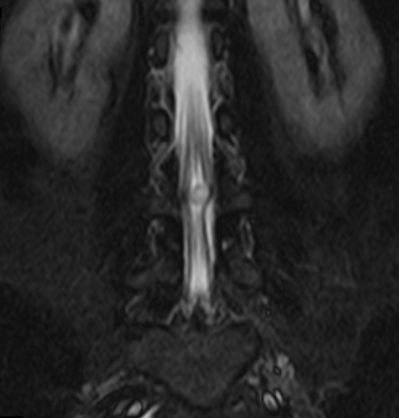 Cauda Equina Tumour-Differentials - Radiology Imaging