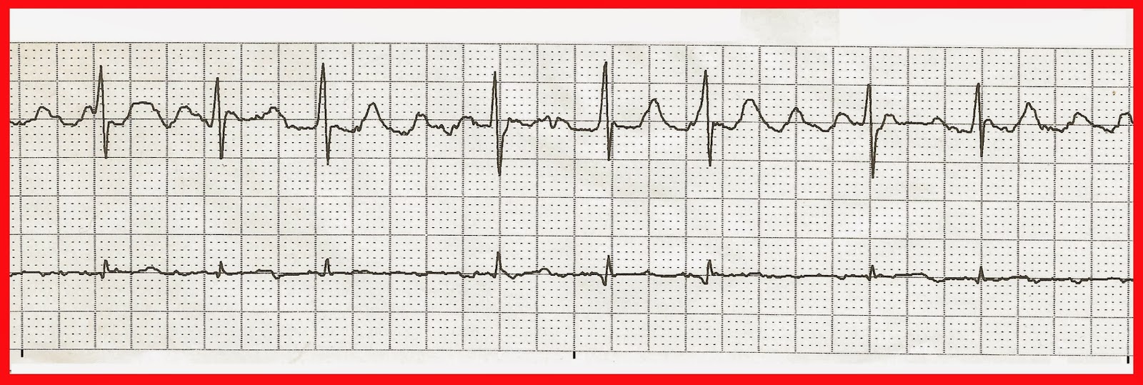 Practice EKG Rhythm Strips 228