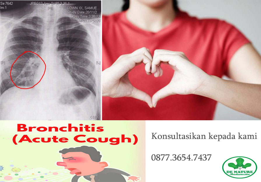 Penyakit tuberkolosis: OBAT AMPUH UNTUK TBC PARU AKTIF