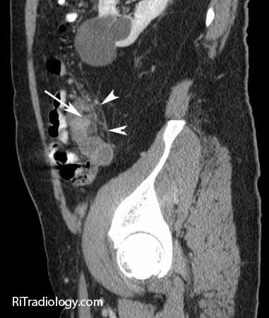 RiT radiology: Ileal Diverticulitis