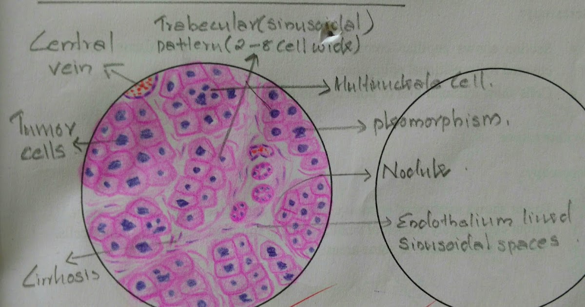 Histopathology Drawings: Hepatocellular carcinoma