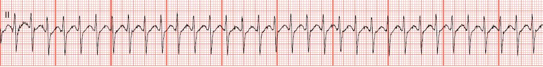 EKG Rhythm Strips 16: Atrial Rhythms