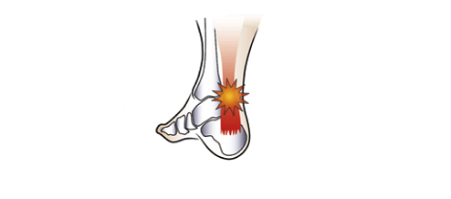 GuttaBoyz innebandy: Vondt i akillesen? Det anbefales eksentriske øvelser