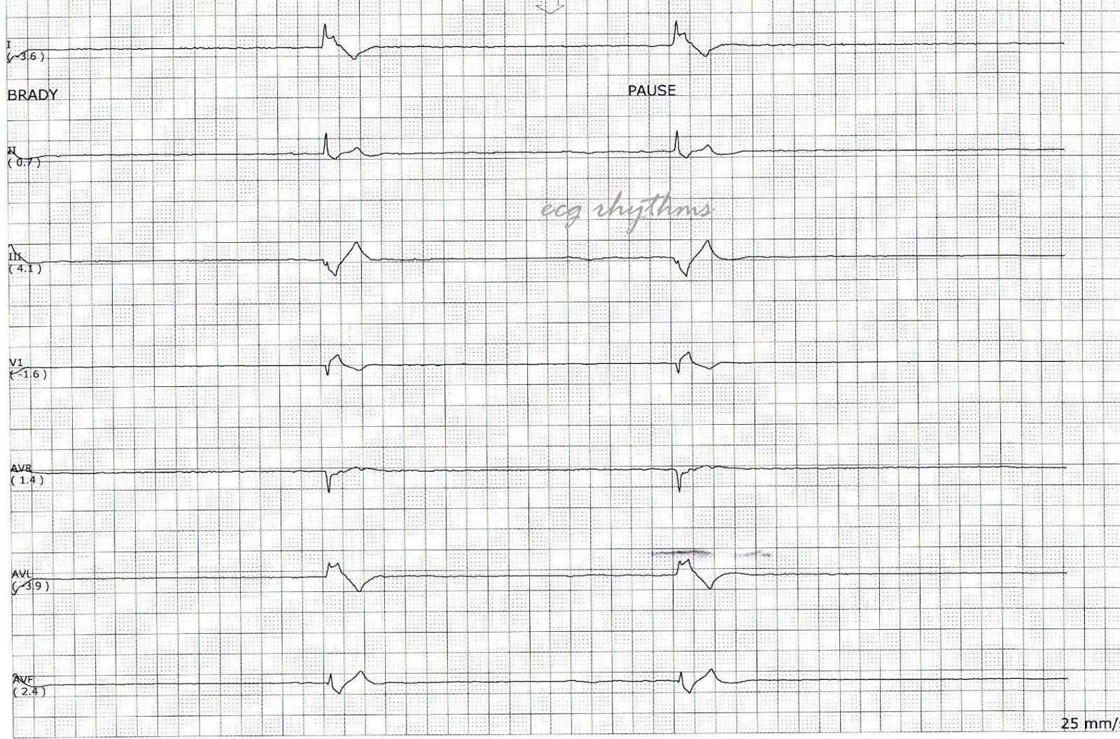 Ekg Rhythms - EKG Heart Rhythms Cheat Sheet - NCLEX Quiz - asaaqaafiyah