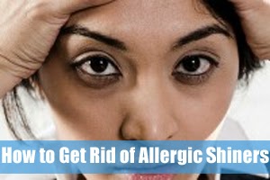 How to Get Rid of Allergic Shiners? Answer Here