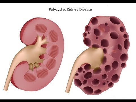 Leczenie PKD: Czy Micro-Medycyna chińska Osmotherapy chirurgii