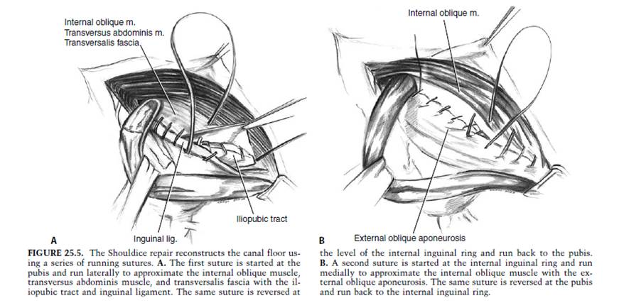 Sudiyatmo,MD Blog & Journal: HERNIA INGUINALIS