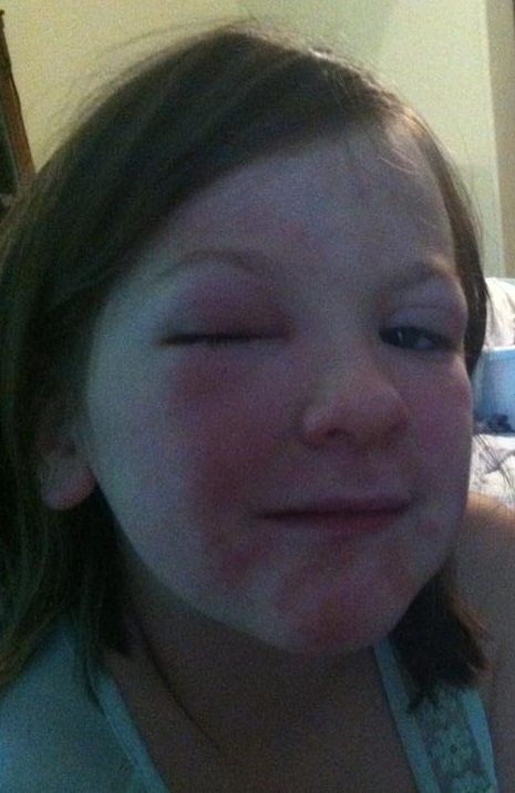 Poison ivy on face - pagfile