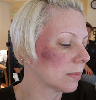 Gothic Horror: Examples of Real Bruises