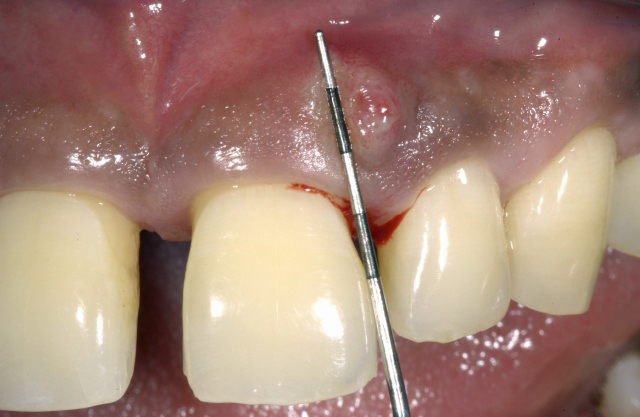 LA NUEVA CARAVANA: PARODONTOSIS MEDICINA NATURAL