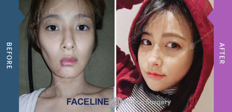 Faceline’s Facial Contouring Revision Surgery: Ploy’s Desperate Real ...