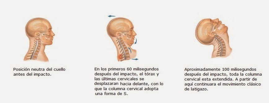 TU SALUD: Latigazo cervical
