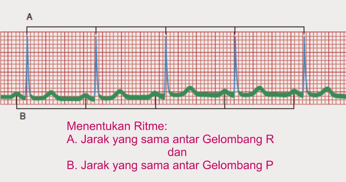 Interpretasi EKG 5 Langkah