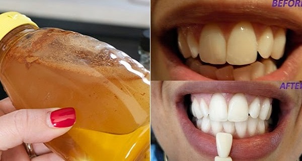 Gargle With One Simple Ingredient And See What Happens To Your Teeth ...