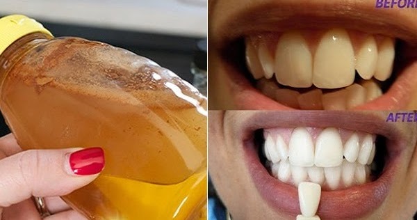 Gargle With One Simple Ingredient And See What Happens To Your Teeth ...