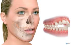 TRASTORNOS DEL LENGUAJE Y LA COMUNICACIÓN: DISGLOSIAS