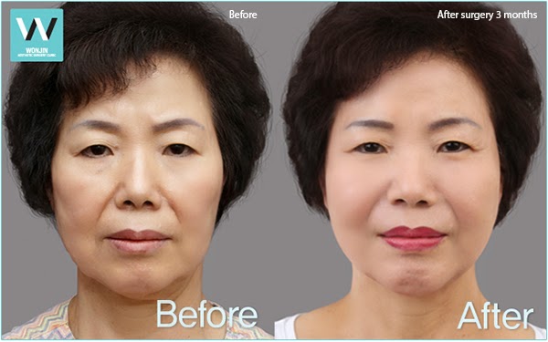 Endotine lifting before and after