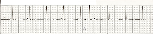 EKG Rhythm Strips 25: Ectopic beats