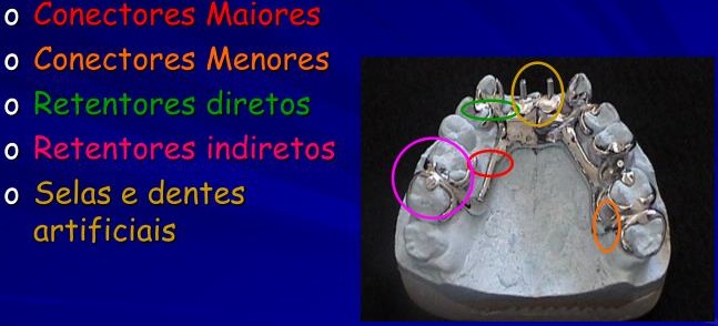 DentistaX: Prótese Parcial Removivel (PPR): Conceitos, objetivos ...