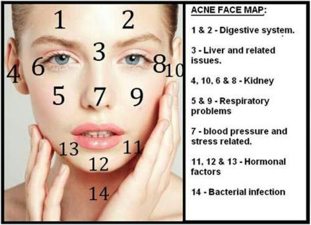 Acne Zones and Causes