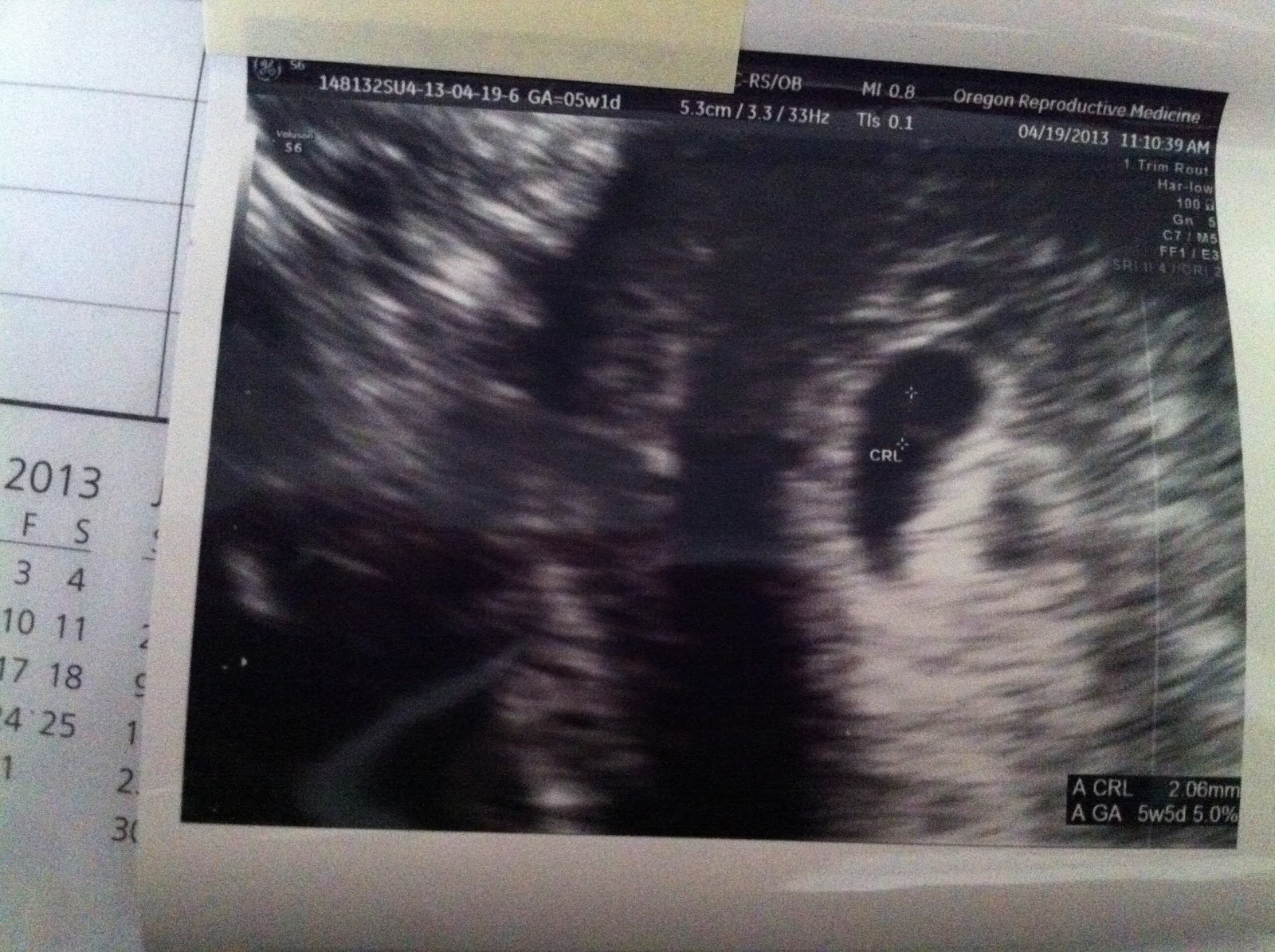 Ready For My Turn: 5w1d ultrasound report