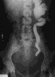 Hydronephrosis (nursing care) ~ Link Nurses