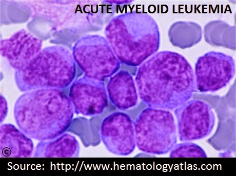 Lab Atlas: Acute Myeloid Leukemia