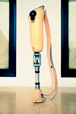 The Silent Stalker: Knee Disarticulation Prosthesis