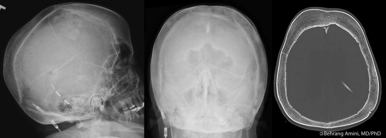 Roentgen Ray Reader: Widened Diploic Space