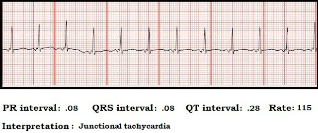 ECG Rhythm Strip Quiz 89: Interval measurements