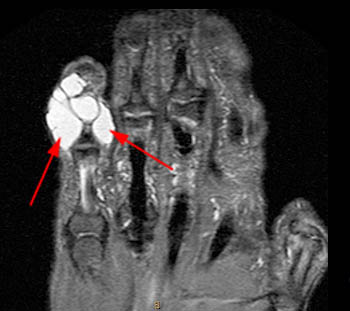 Radiology Pearls: Infrapatellar (Hoffa's fat pad) ganglion cyst