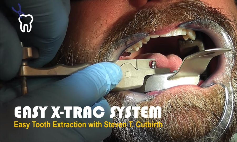 ORAL SURGERY: Easy Tooth Extraction - Steven T. Cutbirth, DDS - Odonto-Tv