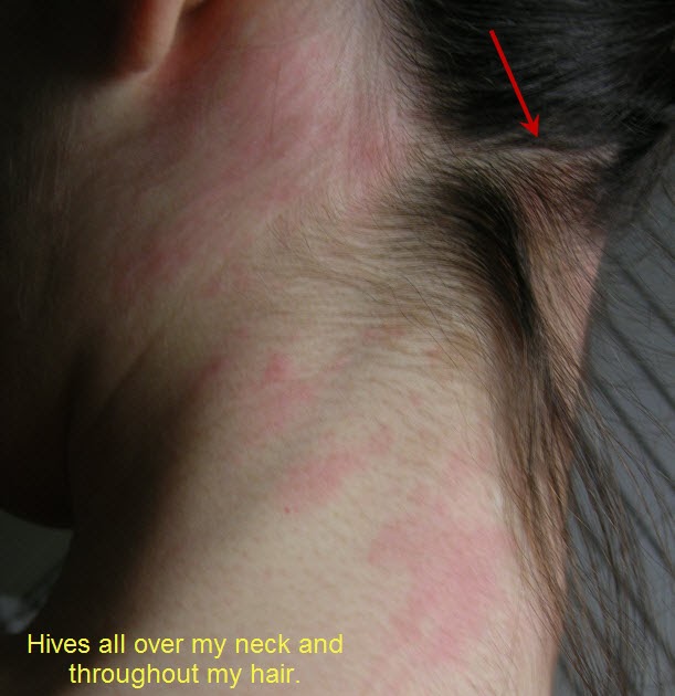 Dana's Healing Journey: And It Begins...Hives