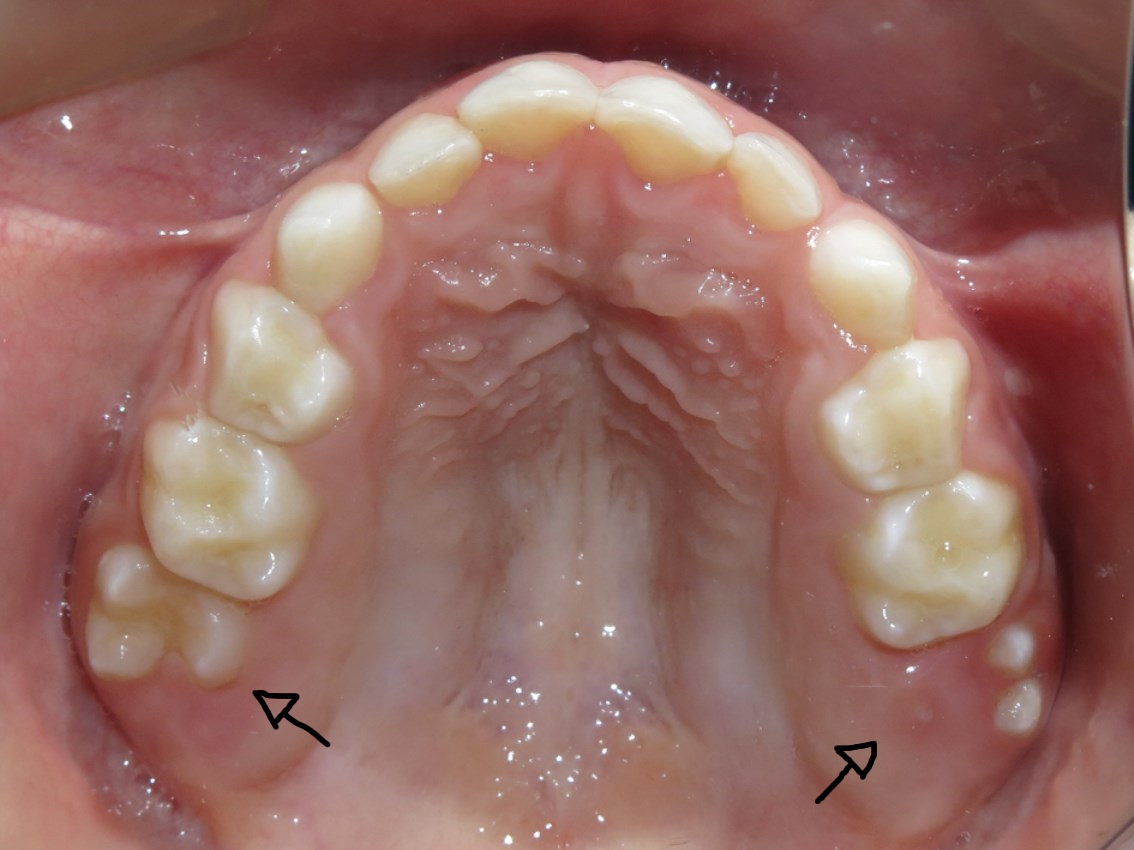 Ortodontia.com.Borel: Primeiro molar permanente.