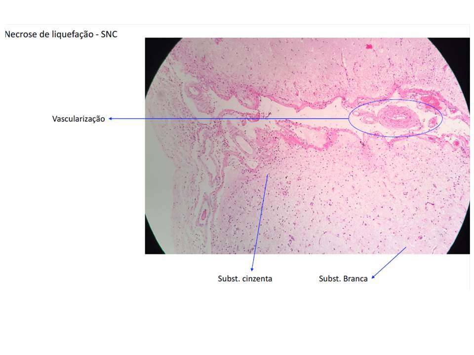 HISTOLOGIA90: TIPOS DE NECROSE