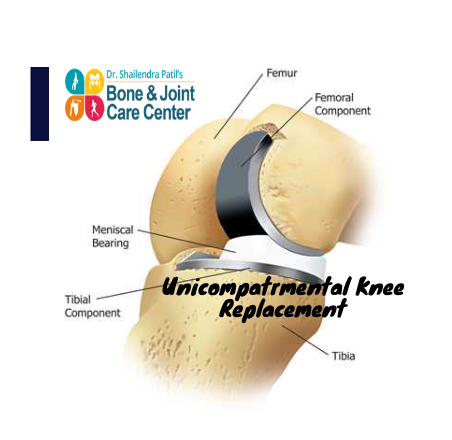 The Current Perspectives Of Unicompartmental Knee Replacement | Bone ...