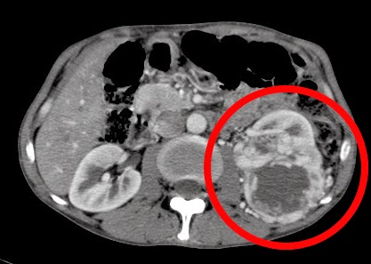 Le cancer du rein | Récap' IDE