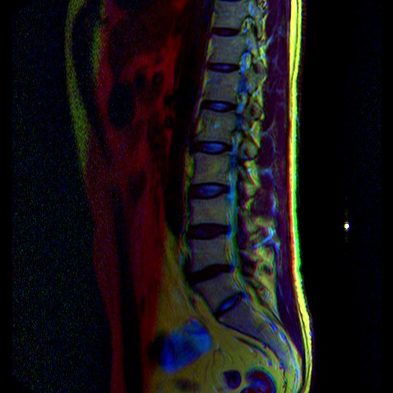 Nevit's blog: Color MRI of Lumbosacral Vertebra
