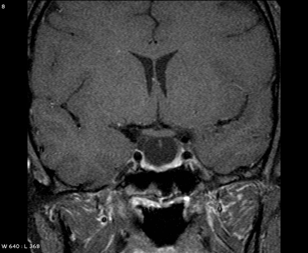 INRA: Sindrome de la silla turca y la importancia de la RMN