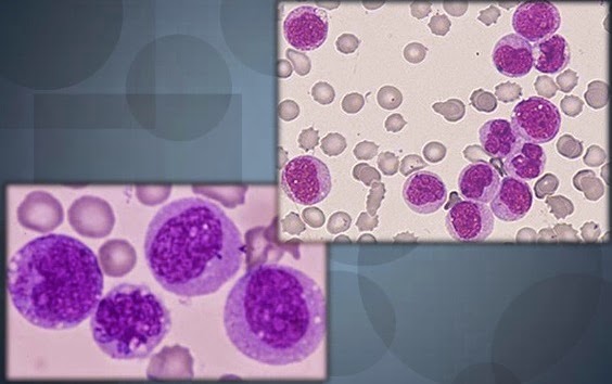 Atlas de hematologia: Leucemia Mielomonocitica Crónica
