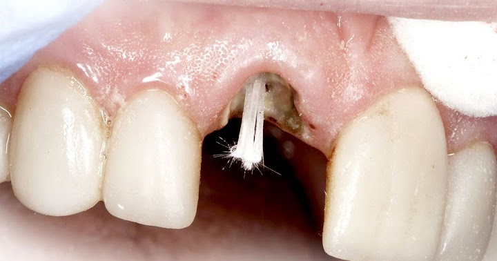 PINTPOST: Minimally Invasive Post and Core - Dentapreg - Odonto-Tv