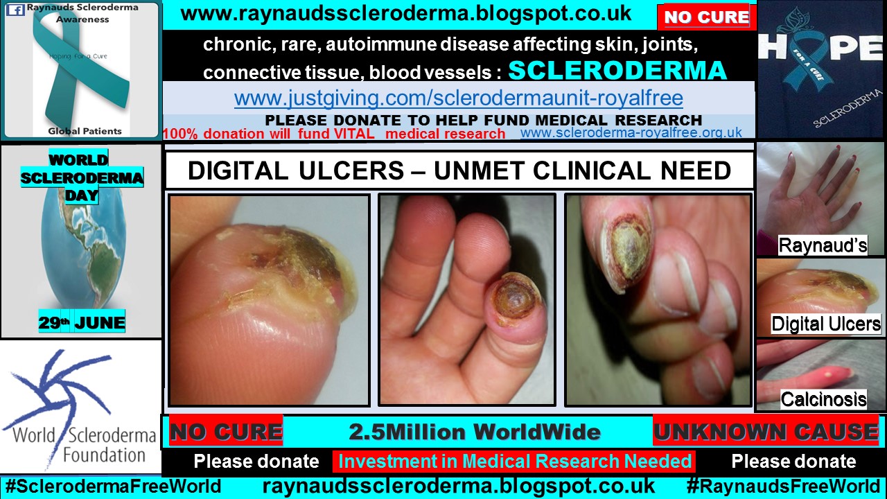 Raynauds Scleroderma Global Patients: Kelli Schrag, USA. June ...