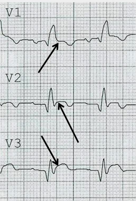 Dr. Smith's ECG Blog: Left ventricular Aneurysm Morphology Distorted by ...