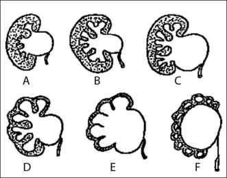L'hydronéphrose | Récap' IDE