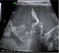 SONO DIGEST: EPIPLOIC APPENDAGITIS - An ultrasound diagnosis